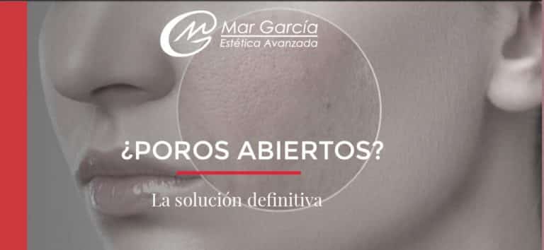 Poros abiertos y dilatados en la cara: Cómo tratarlos